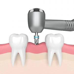 Jawbone resorption and dental implants at Wonders dentistry
